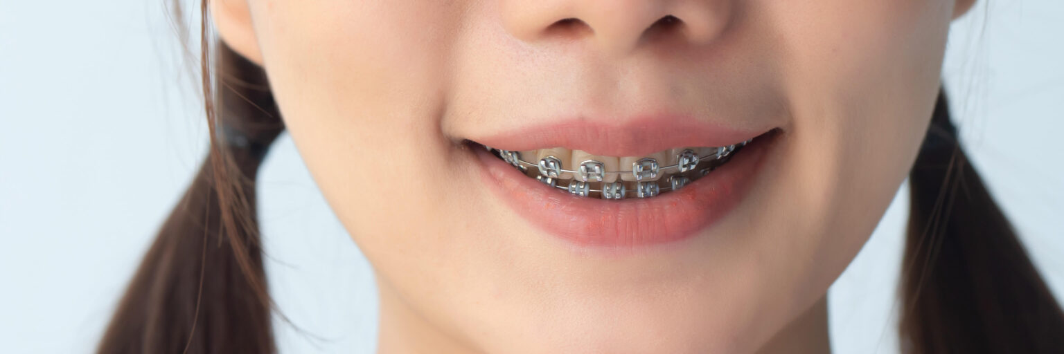 A Comprehensive Guide to Preparing Your Child for Orthodontic Treatment ...